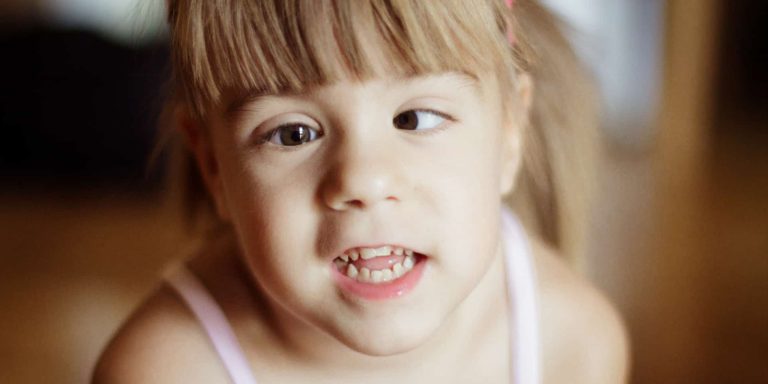 Strabismus (crossed eyes) – BC Doctors of Optometry